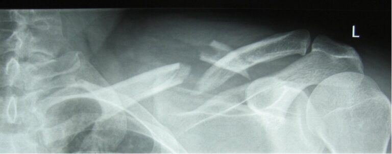 Breuk van het sleutelbeen - Orthopedie Lier : Orthopedie Lier