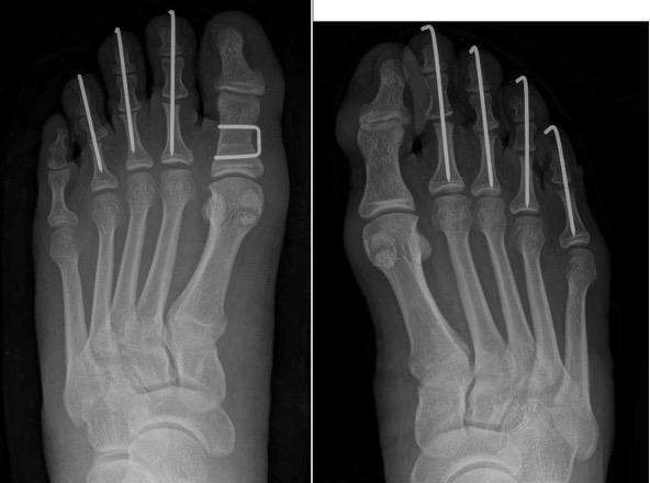 Hamertenen - Orthopedie Lier : Orthopedie Lier