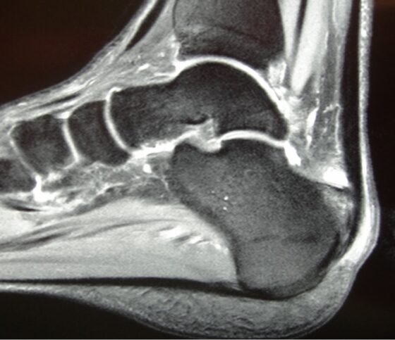 Haglund exostose of syndroom - Orthopedie Lier : Orthopedie Lier