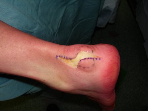 Haglund exostose of syndroom - Orthopedie Lier : Orthopedie Lier