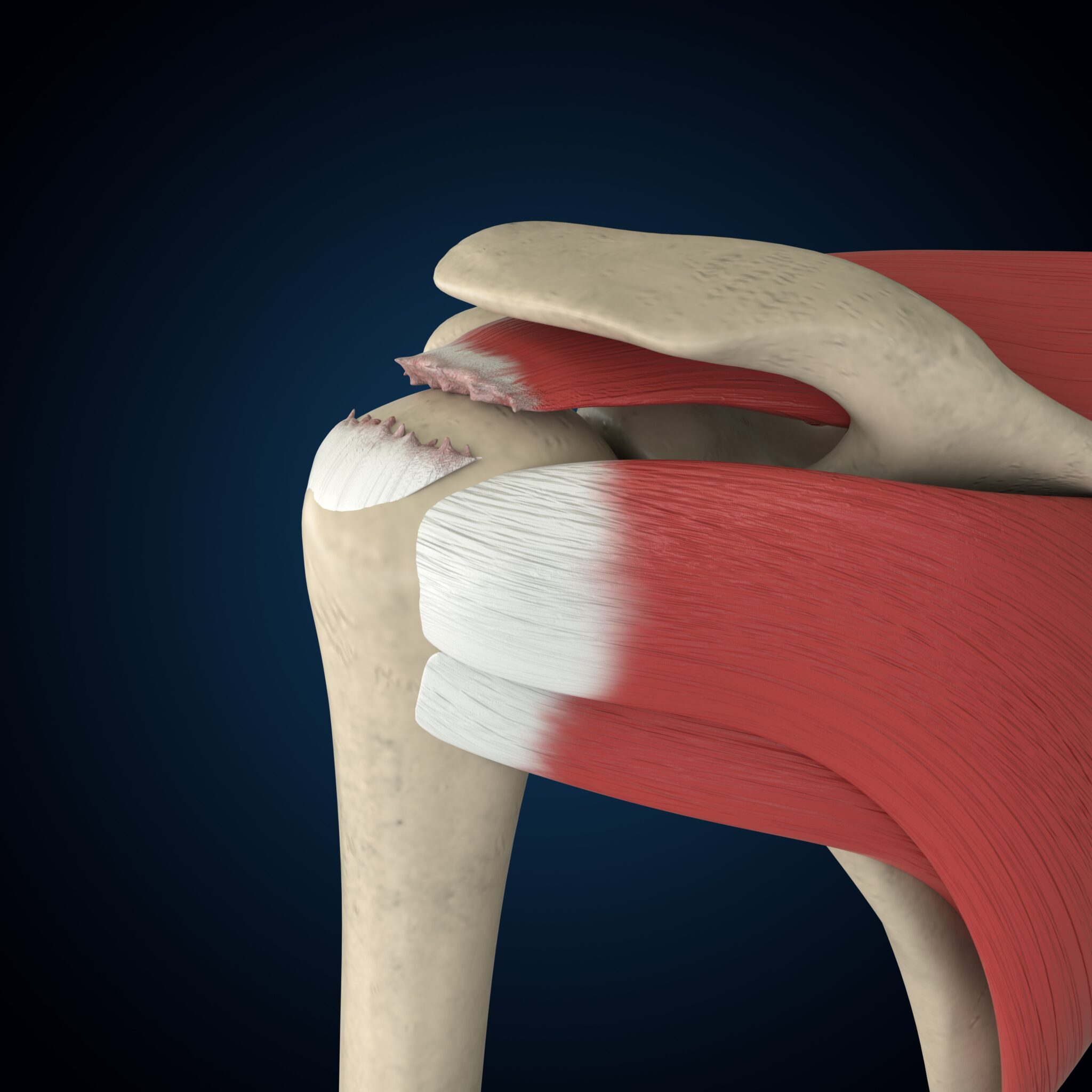 Peesscheur van de schouder (rotator cuff scheur) - Orthopedie Lier ...