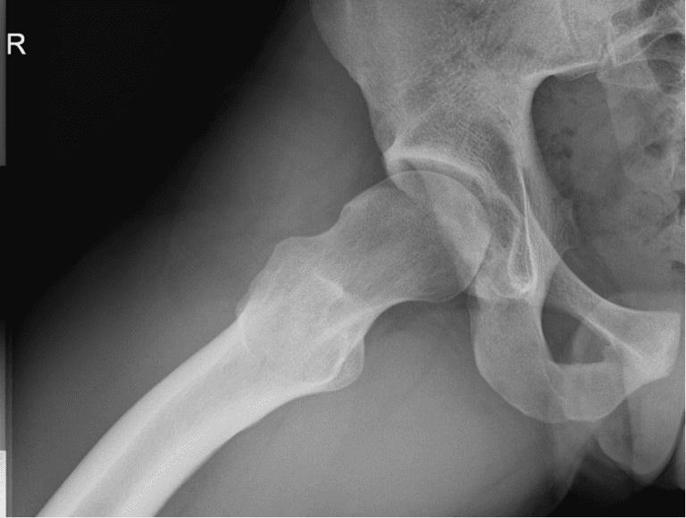 Heupinklemming of impingement - Orthopedie Lier : Orthopedie Lier