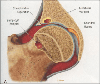 Heupinklemming of impingement - Orthopedie Lier : Orthopedie Lier