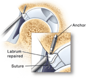 Heupinklemming of impingement - Orthopedie Lier : Orthopedie Lier