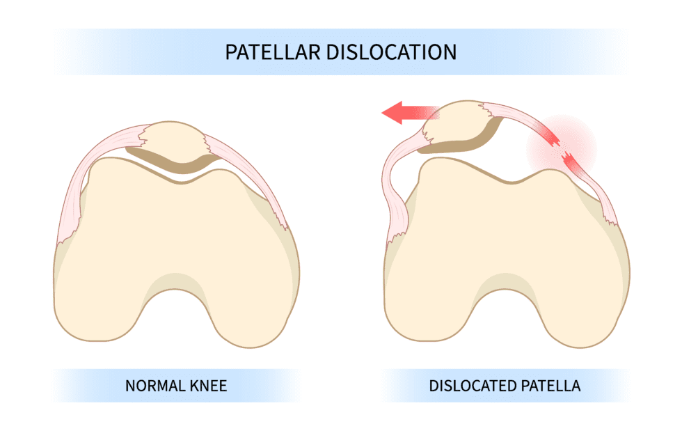Instabiliteit van de knieschijf - Orthopedie Lier : Orthopedie Lier