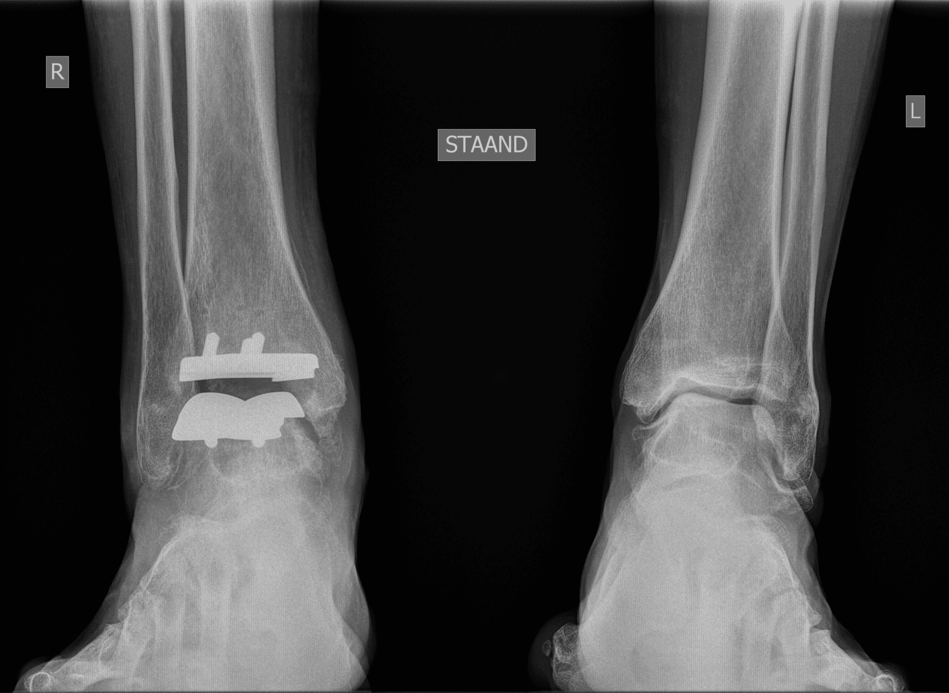 Artrose van de enkel - Orthopedie Lier : Orthopedie Lier