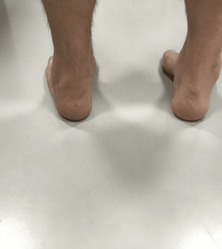 Chronische enkelinstabiliteit - Orthopedie Lier : Orthopedie Lier