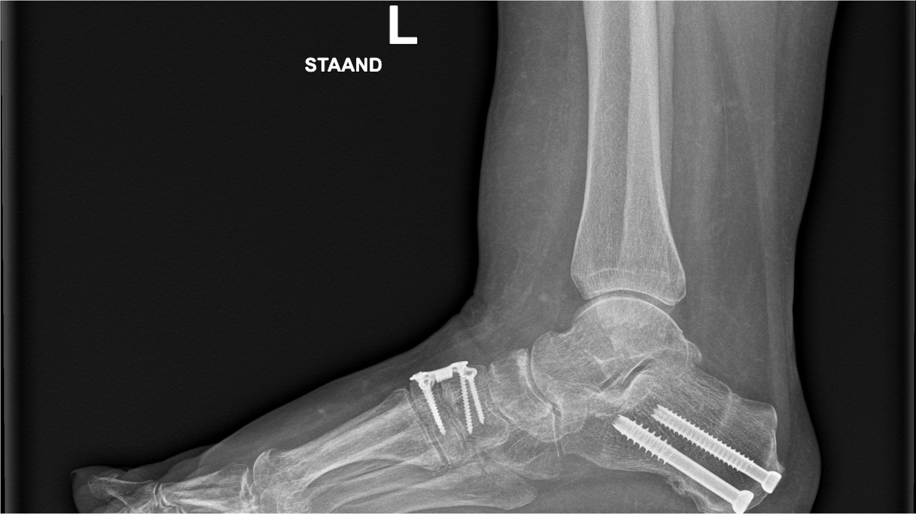 Platvoet of pes planus - Orthopedie Lier : Orthopedie Lier