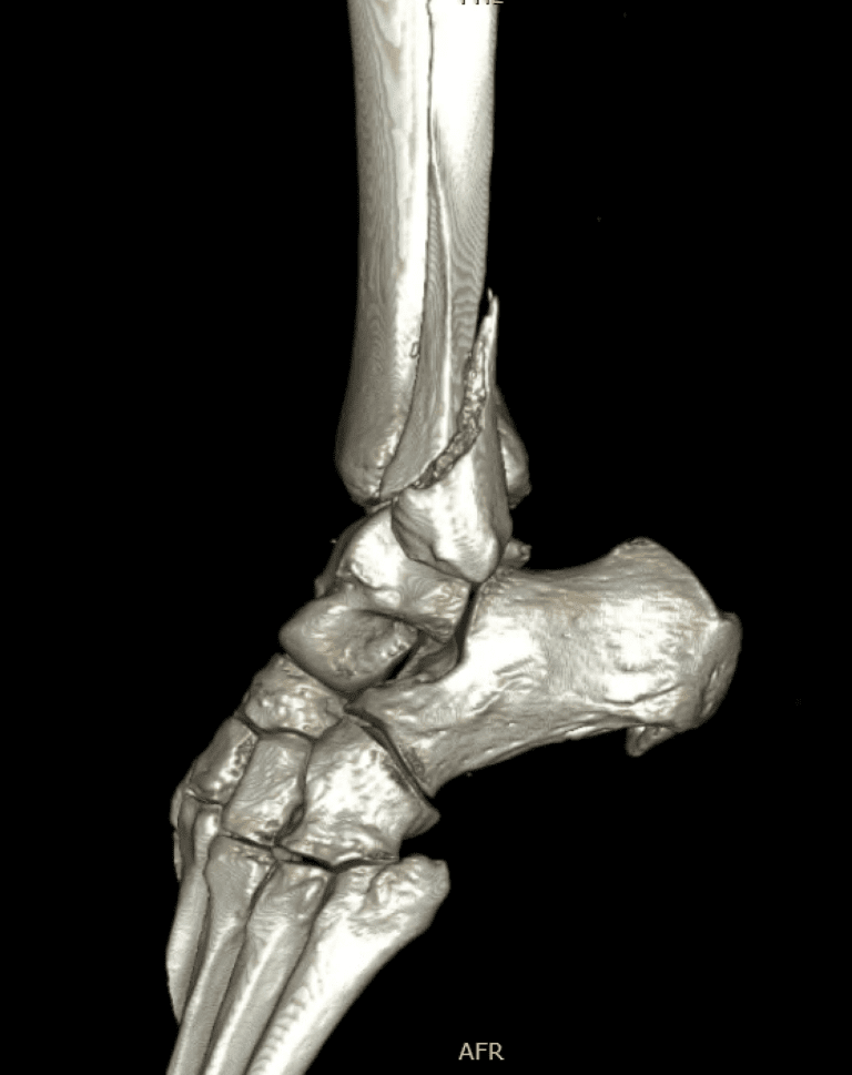 Enkelbreuk - Orthopedie Lier : Orthopedie Lier