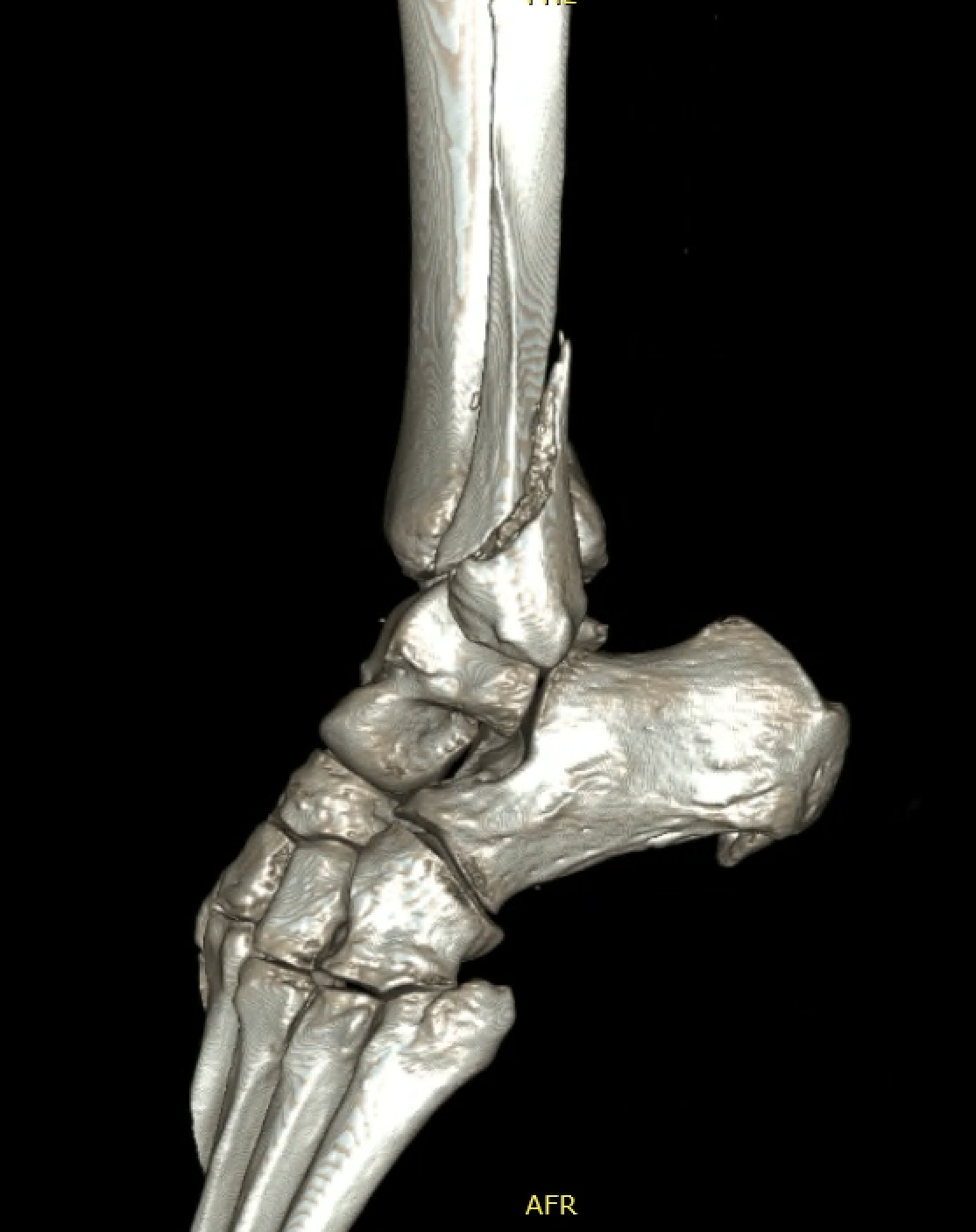 Enkelbreuk - Orthopedie Lier : Orthopedie Lier