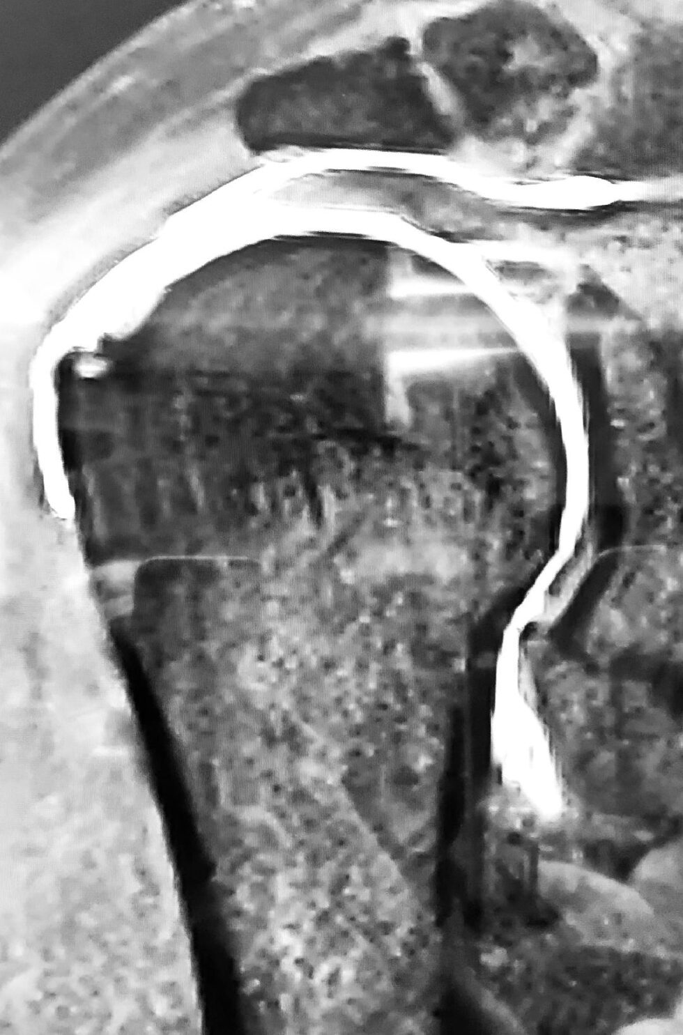 Padel blessures. Meer voorkomend dan je denkt. Onze knie- en ...