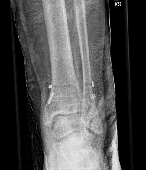 Chronische enkelinstabiliteit - Orthopedie Lier : Orthopedie Lier